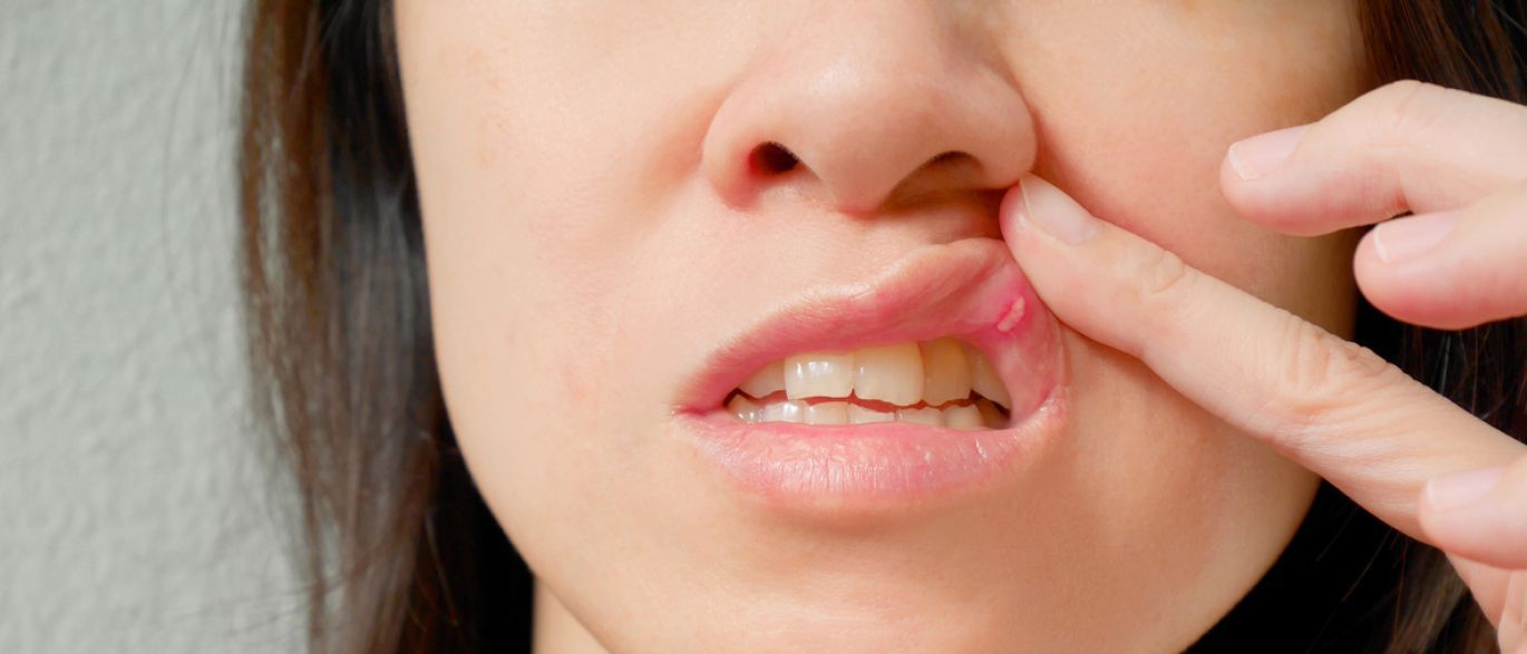 O que são Aftas? – Orthofono Odontologia