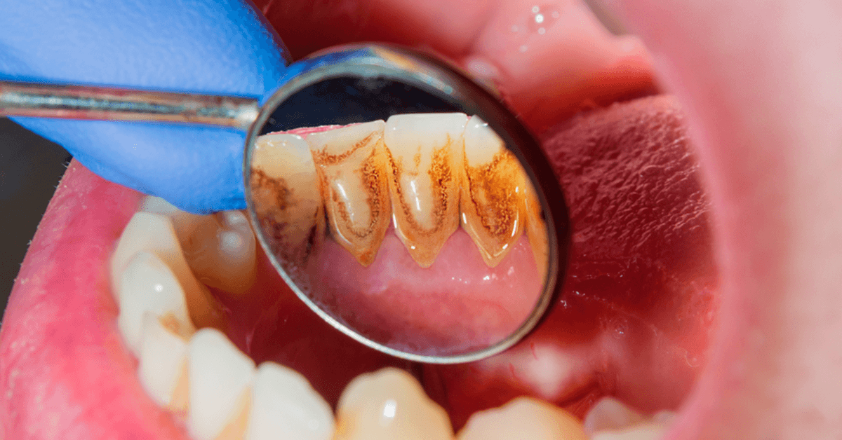 Cárie crônica – Saiba o que é – Orthofono Odontologia